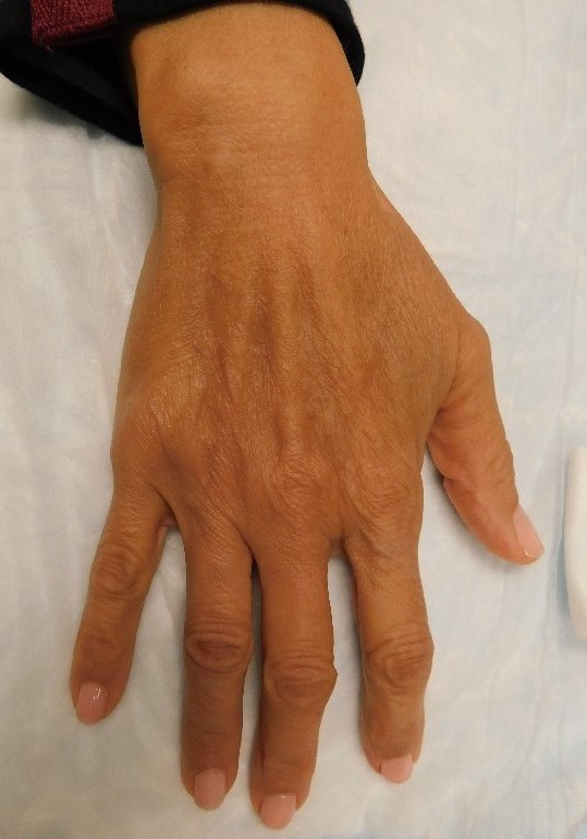 Hand Veins Sclerotherapy, York Vein Clinic, 95 Wellington Street East ...